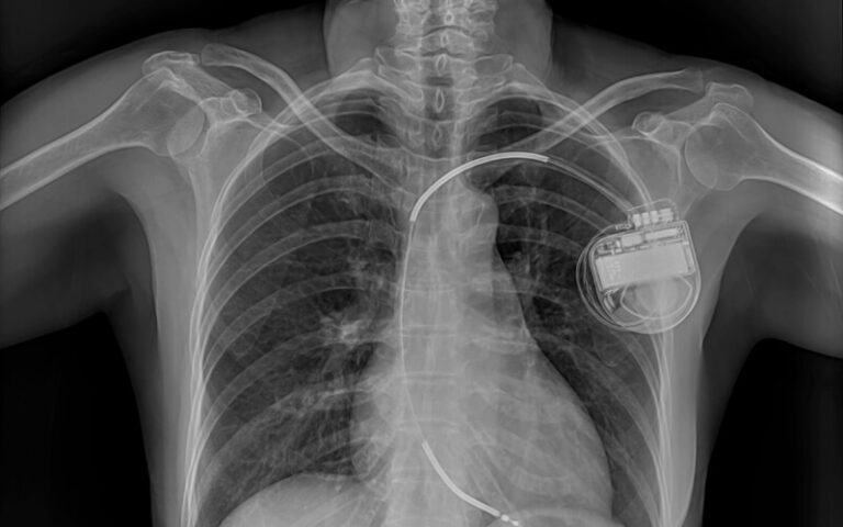Successful Pacemaker Surgery Procedure | Calwin Hospitals